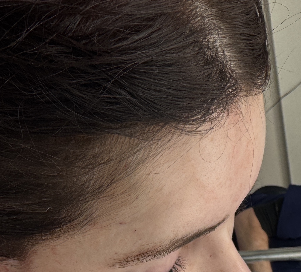 Female Custom Forehead Implant Augmentation Case Study - Explore ...