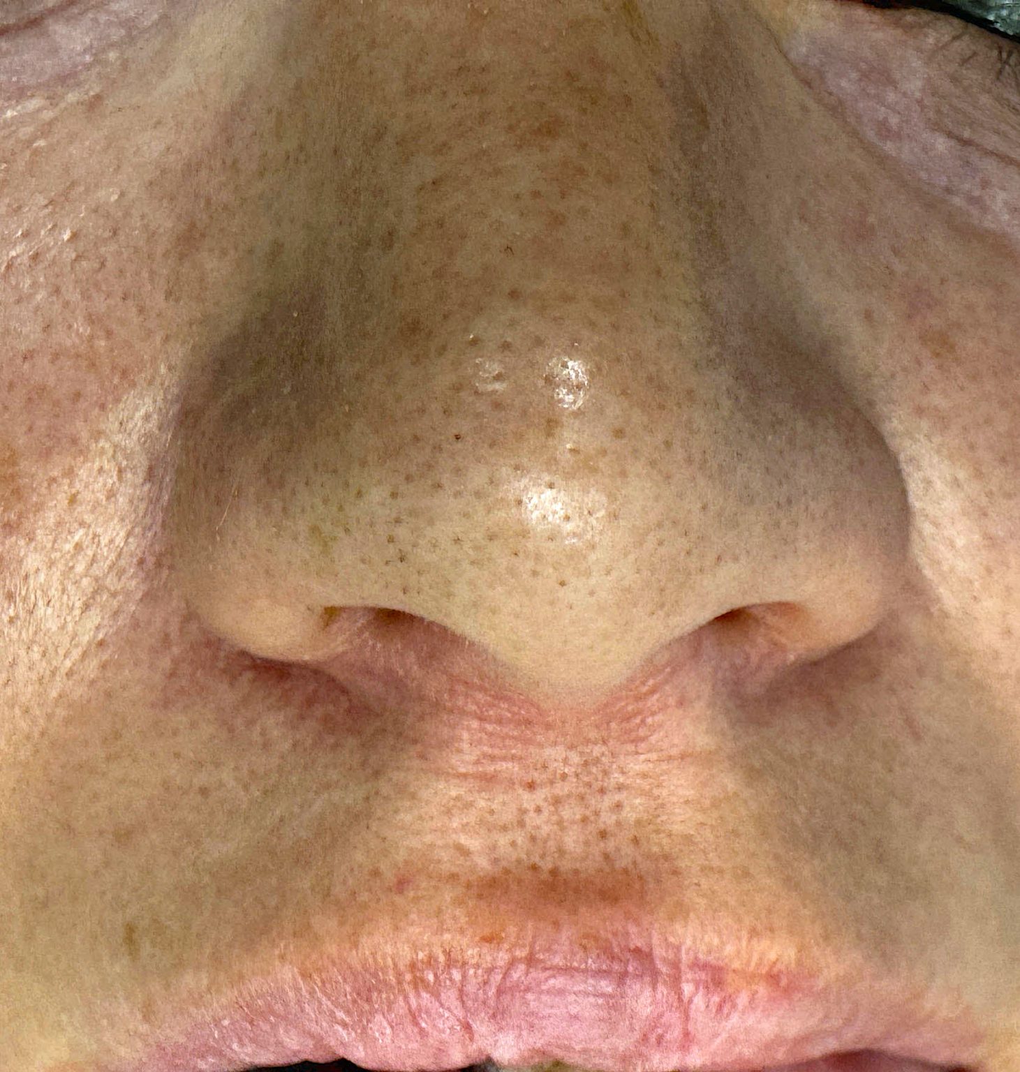 Nostrol Lowering for ASsymmetry Correction - Case Study - Explore ...