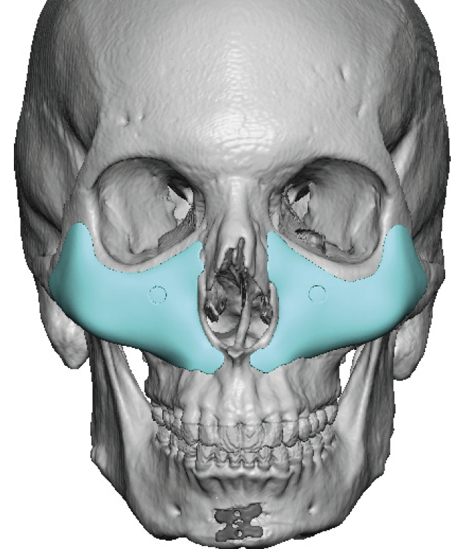 The Custom MIdface Mask Implant - Indications and Benefits - Explore ...