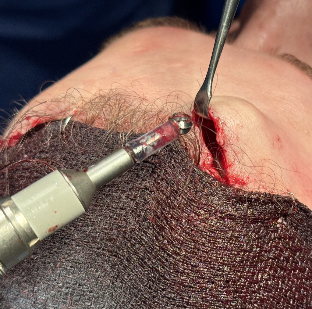 Forehead Horn Reduction Case Study - Explore Plastic Surgery