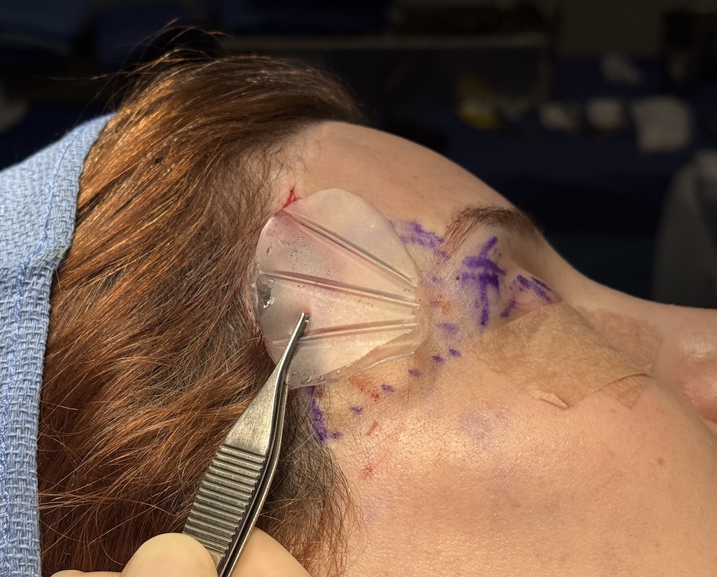 Temple Hollowing and Volume Restoration Options - Explore Plastic Surgery