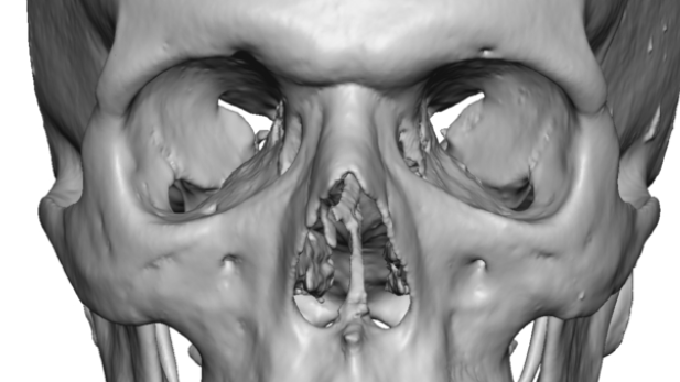 Ciustom Infraorbital-Malar Implants in Negative Orbital Vector Anatomy ...