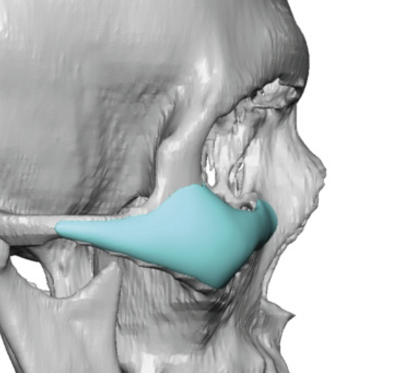 Custom Cheek Implants and Zygmatic Arch Augmentation - Explore Plastic ...