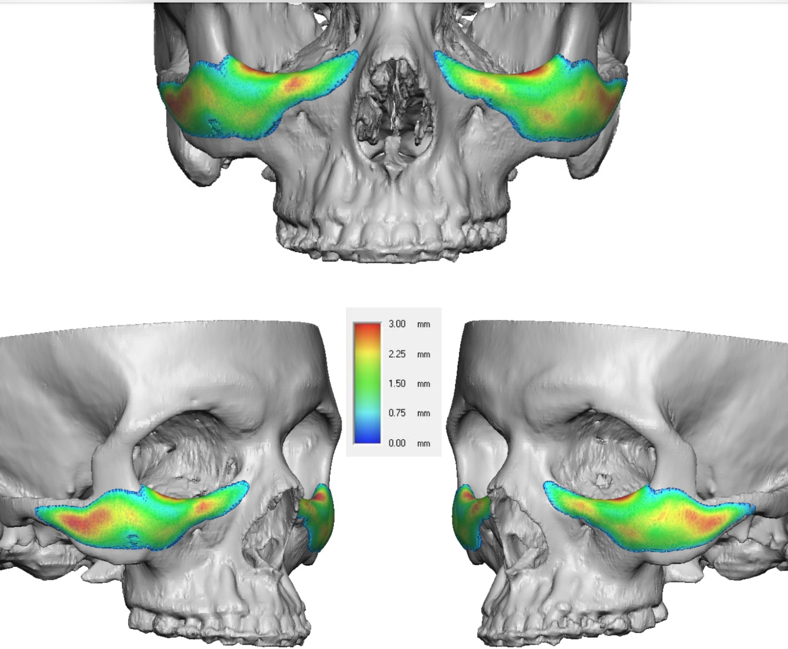 Custom MIdface Implant Thickness Design Guidelines By Sex - Explore ...