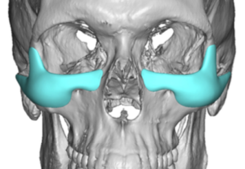 Custom Infraorbital vs Infraorbital-Malar Implant Comparison - Explore ...