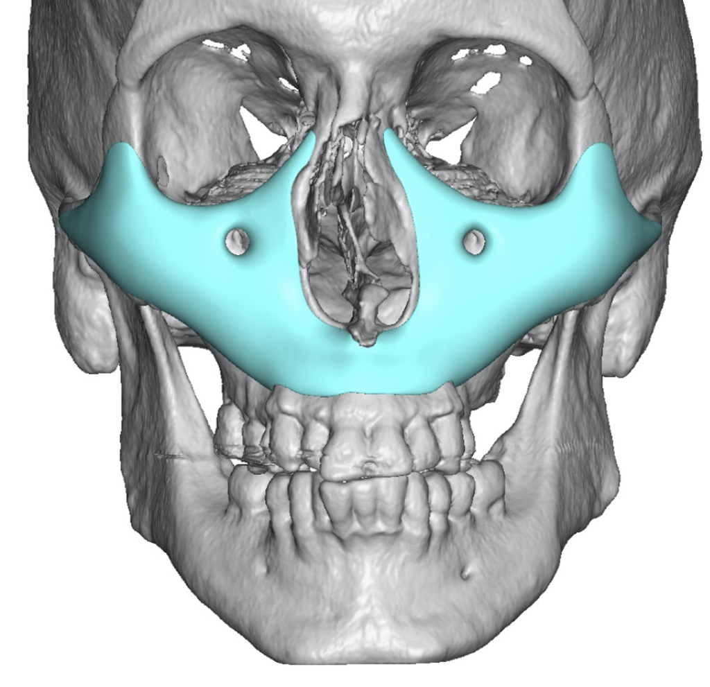 The Custom MIdface Mask Implant - Indications and Benefits - Explore ...