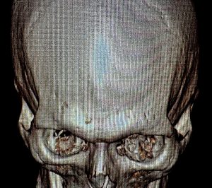 Adult Male Metopic Ridge Reduction - Case Study - Explore Plastic Surgery