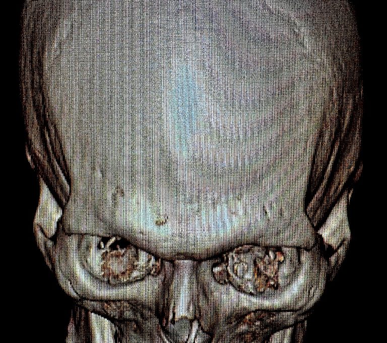 Adult Male Metopic Ridge Reduction - Case Study - Explore Plastic Surgery