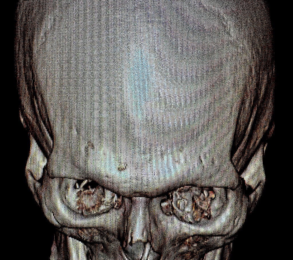 Adult Male Metopic Ridge Reduction - Case Study - Explore Plastic Surgery
