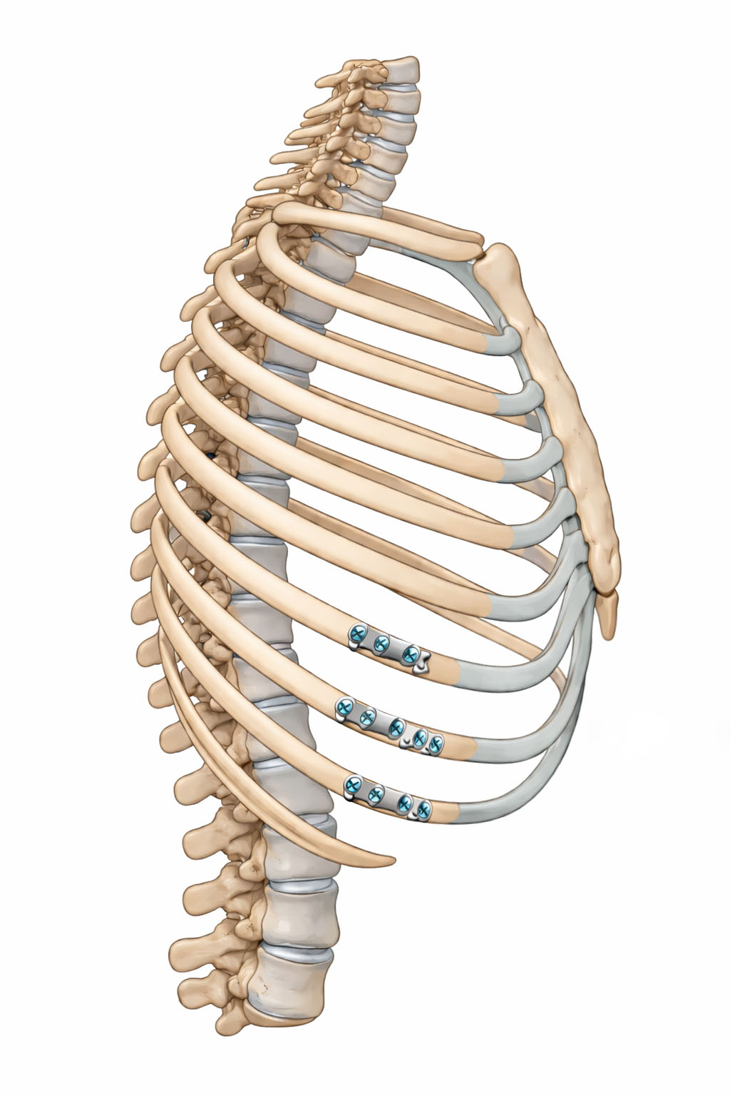 Ribcage Reshaping Osteotomies for Subcostal Rib Flare - Explore Plastic ...