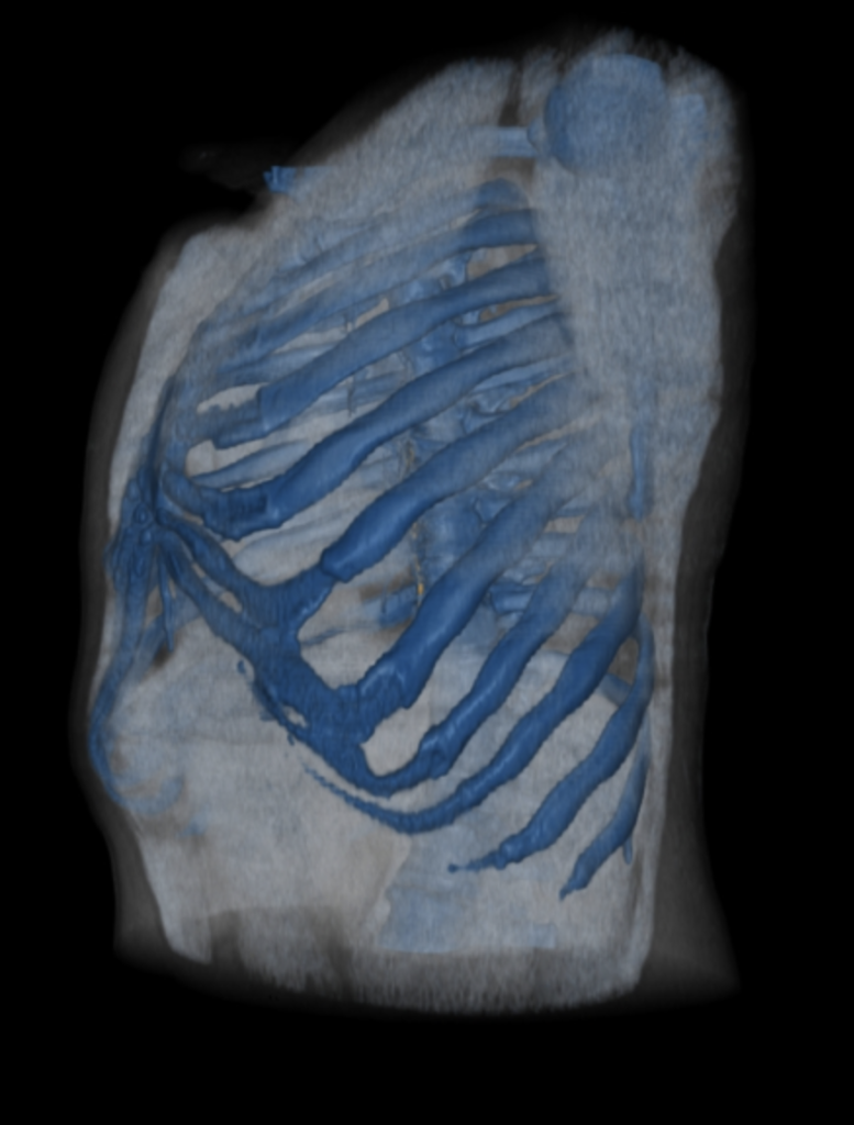 Rib 11–12 (Type 1) vs Rib 10–12 (Type 2) Resection in Advanced Waist ...