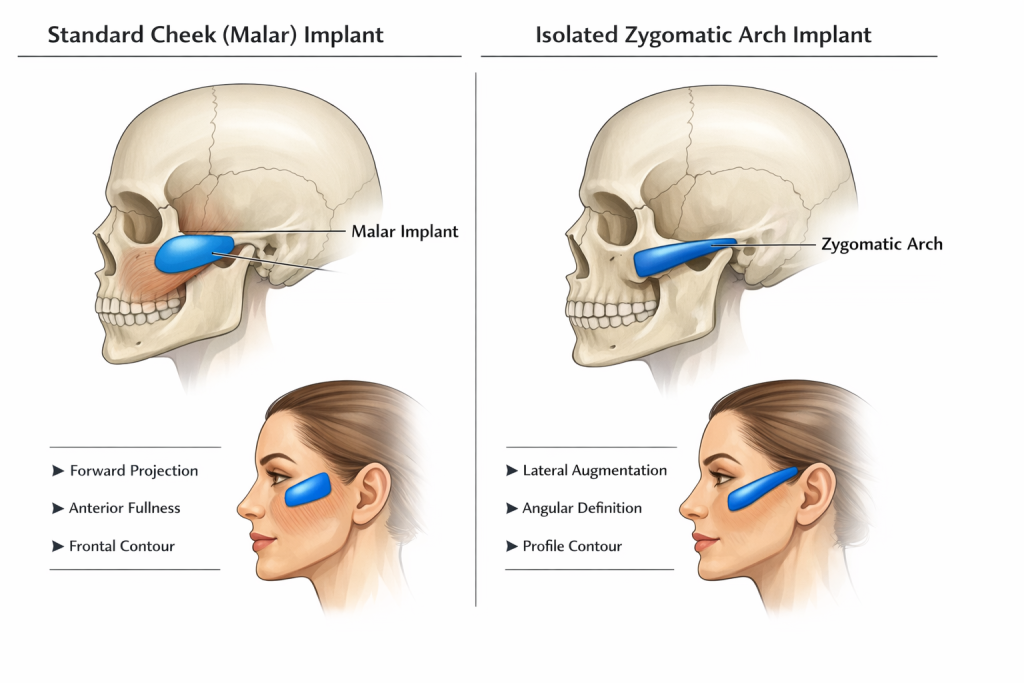 Isolated Zygomatic Arch Implants: Anatomical Considerations, Aesthetic ...