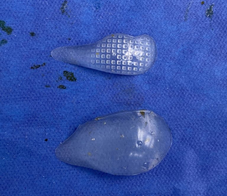 Custom Midface Implants vs Off-The-Shelf (Standard) Midface Implants ...