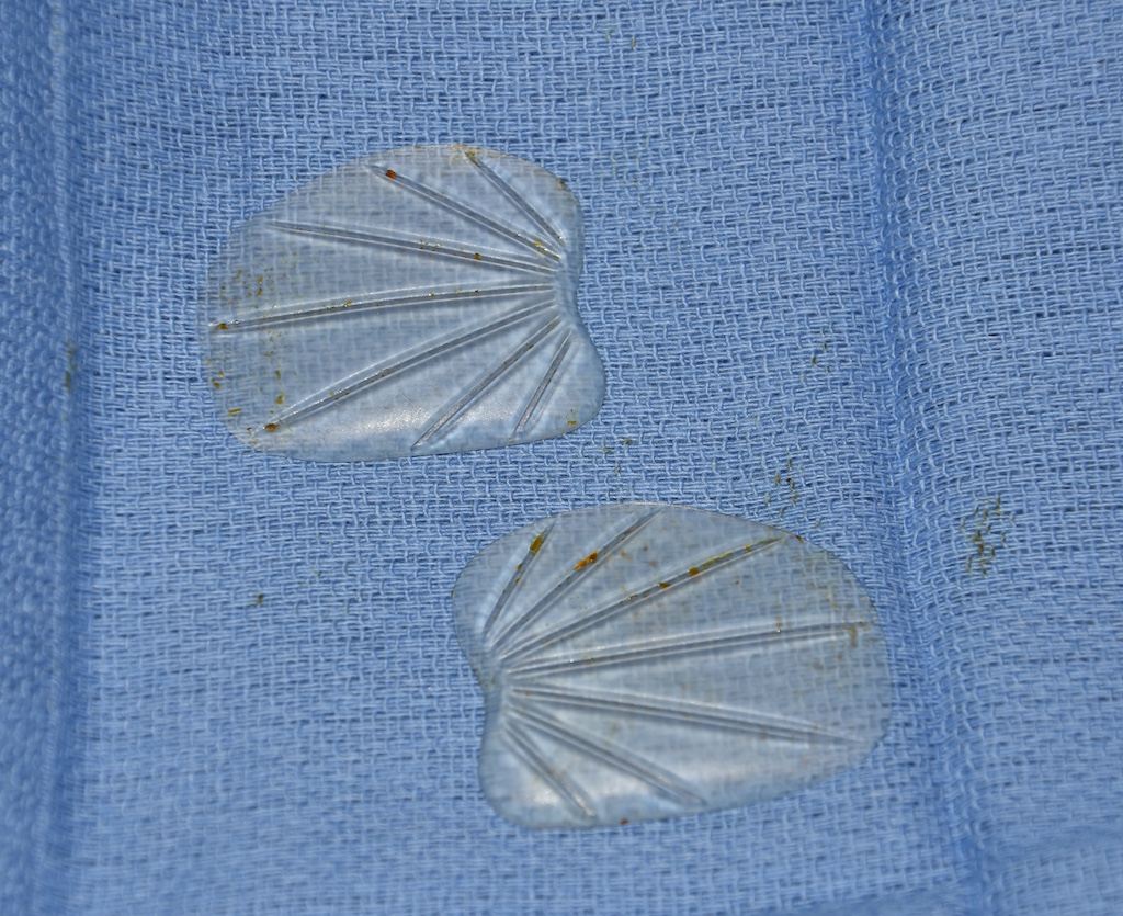 Temple Hollowing and Volume Restoration Options - Explore Plastic Surgery