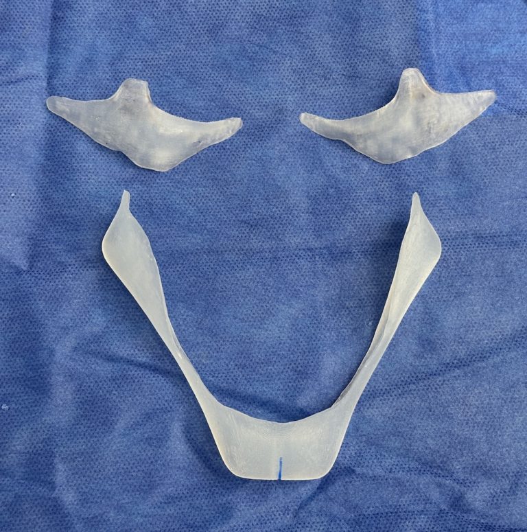 What Are Custom Infraorbital-Malar & Jawline Implants? - Explore ...