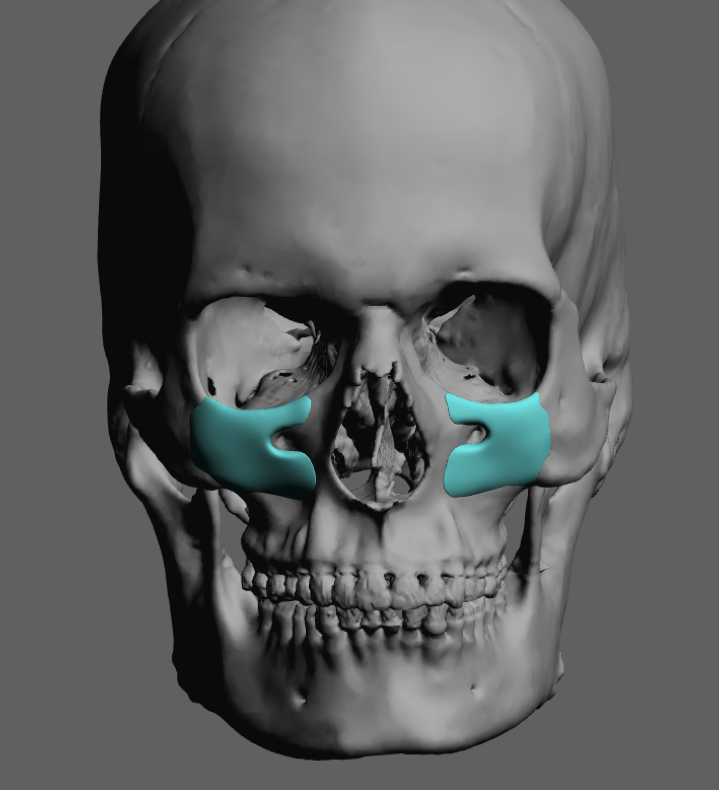 Custom Infraorbital–Maxillary Implants - Case Example and Design ...