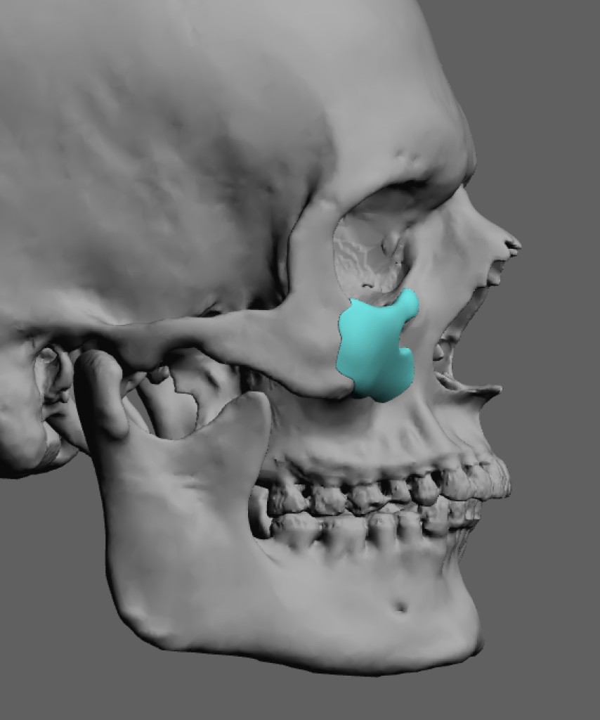 Custom Infraorbital–Maxillary Implants - Case Example and Design ...