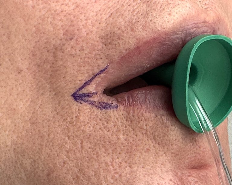 Male Mouth Widening Case Example - Explore Plastic Surgery