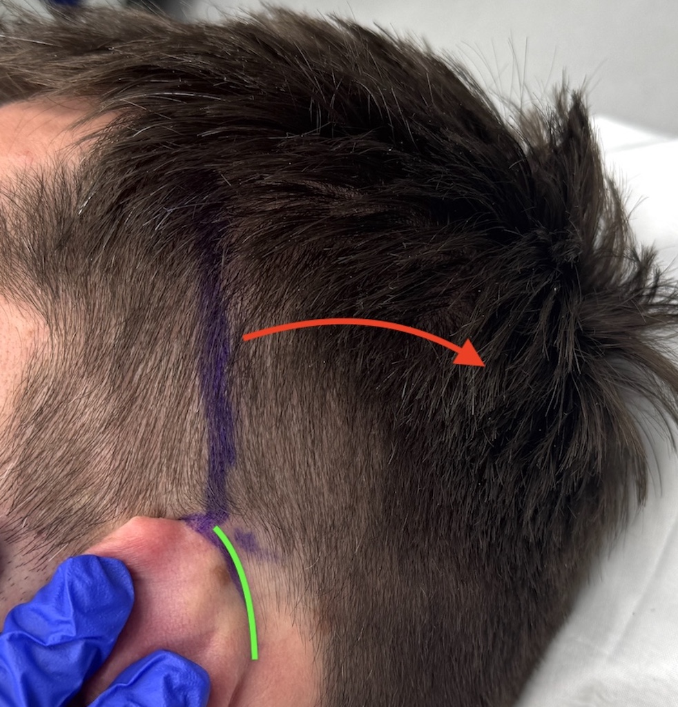 The Postauricular Incision in Aesthetic Temporal Reduction Surgery ...