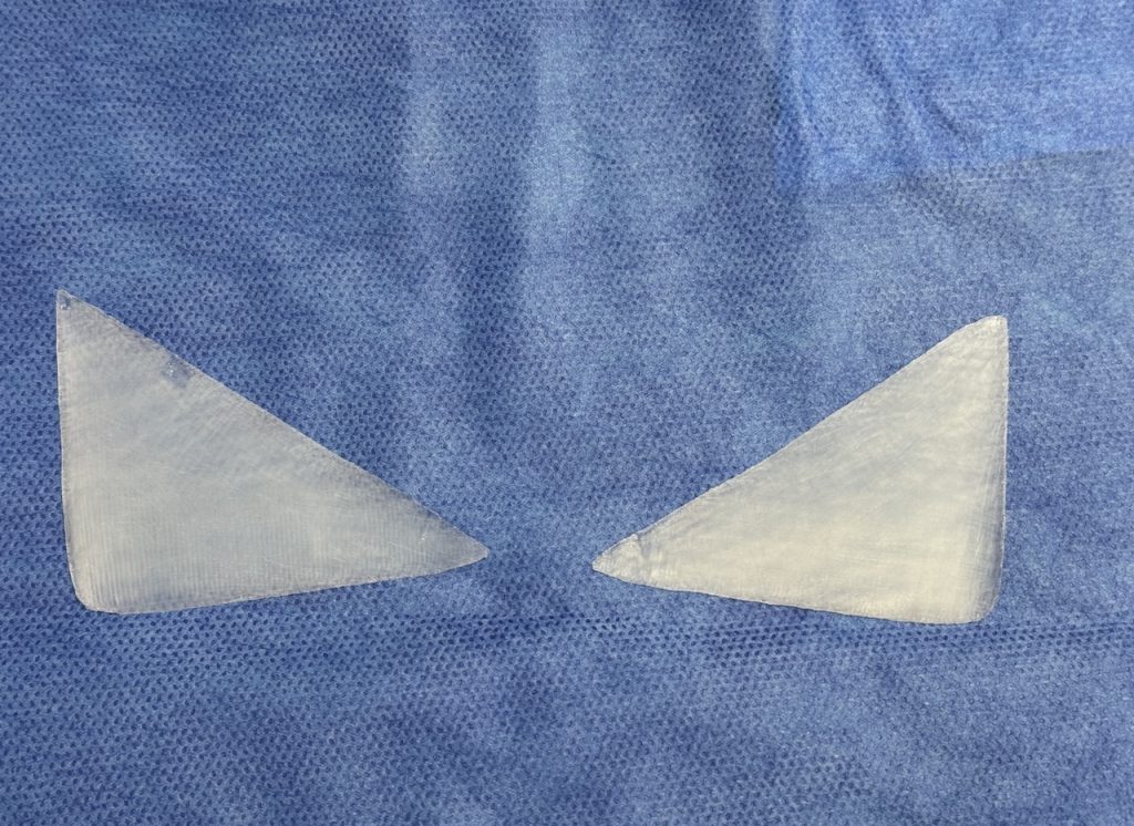 Soft-Tissue Implants for Jaw Angle Augmentation - Explore Plastic Surgery