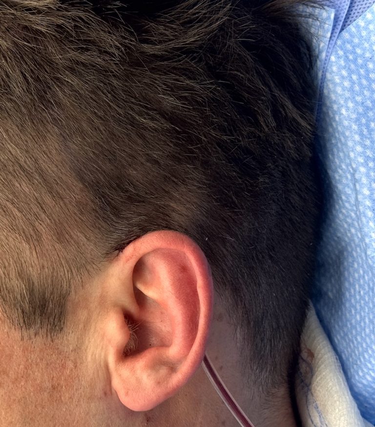 The Postauricular Incision in Aesthetic Temporal Reduction Surgery ...