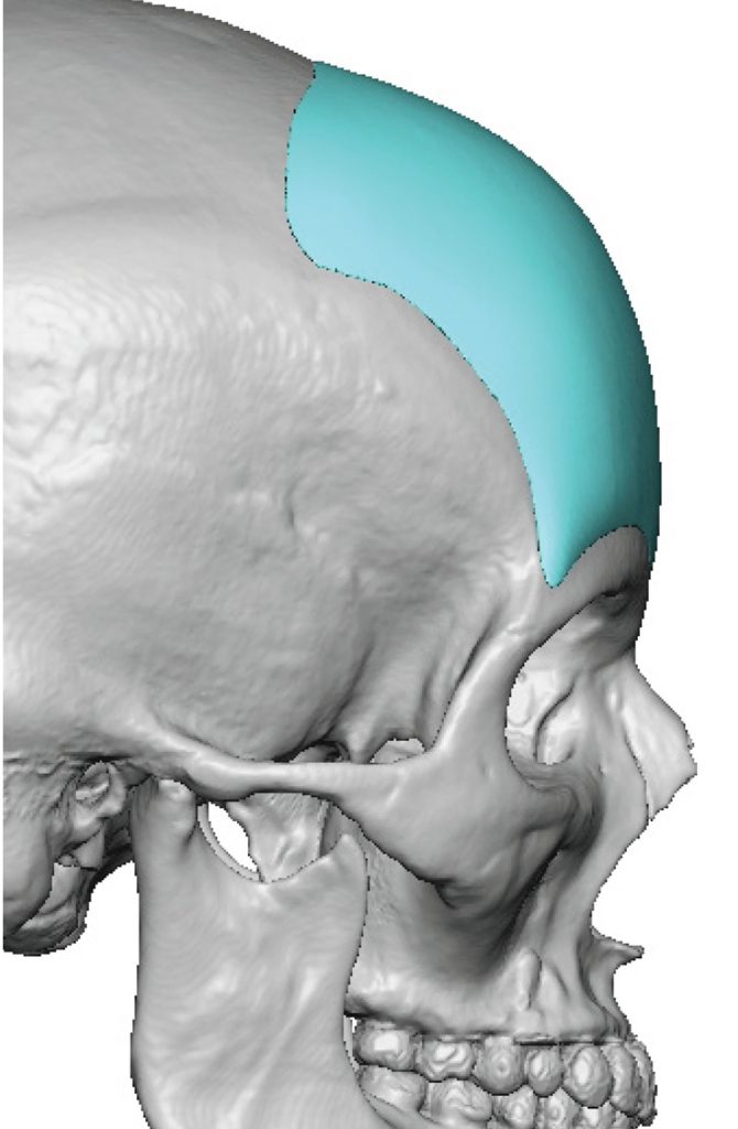 The Wide Diversity of Custom Forehead Implant Designs and Aesthetic ...