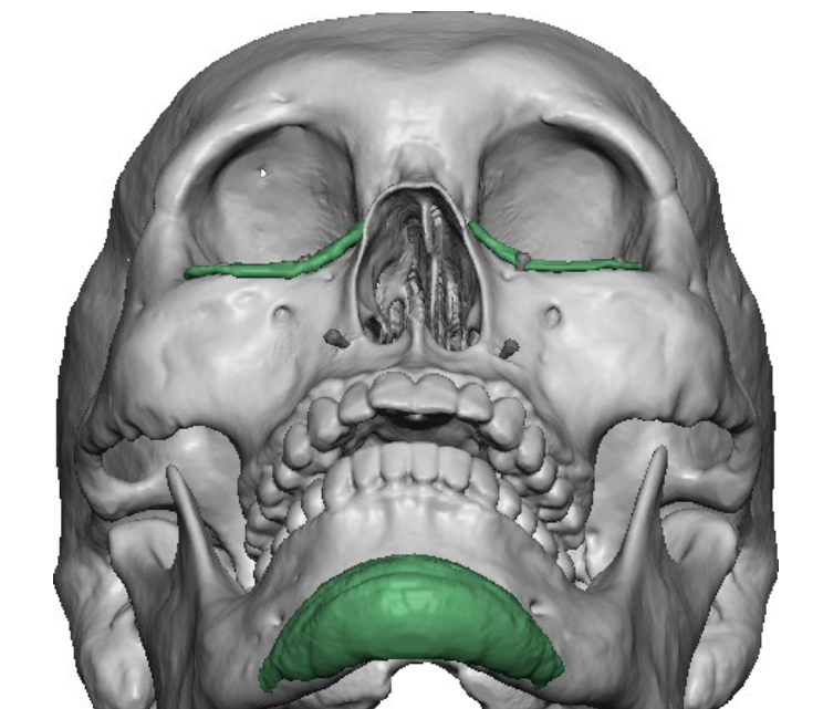 flat midface submental view Dr Barry Eppley - Explore Plastic Surgery