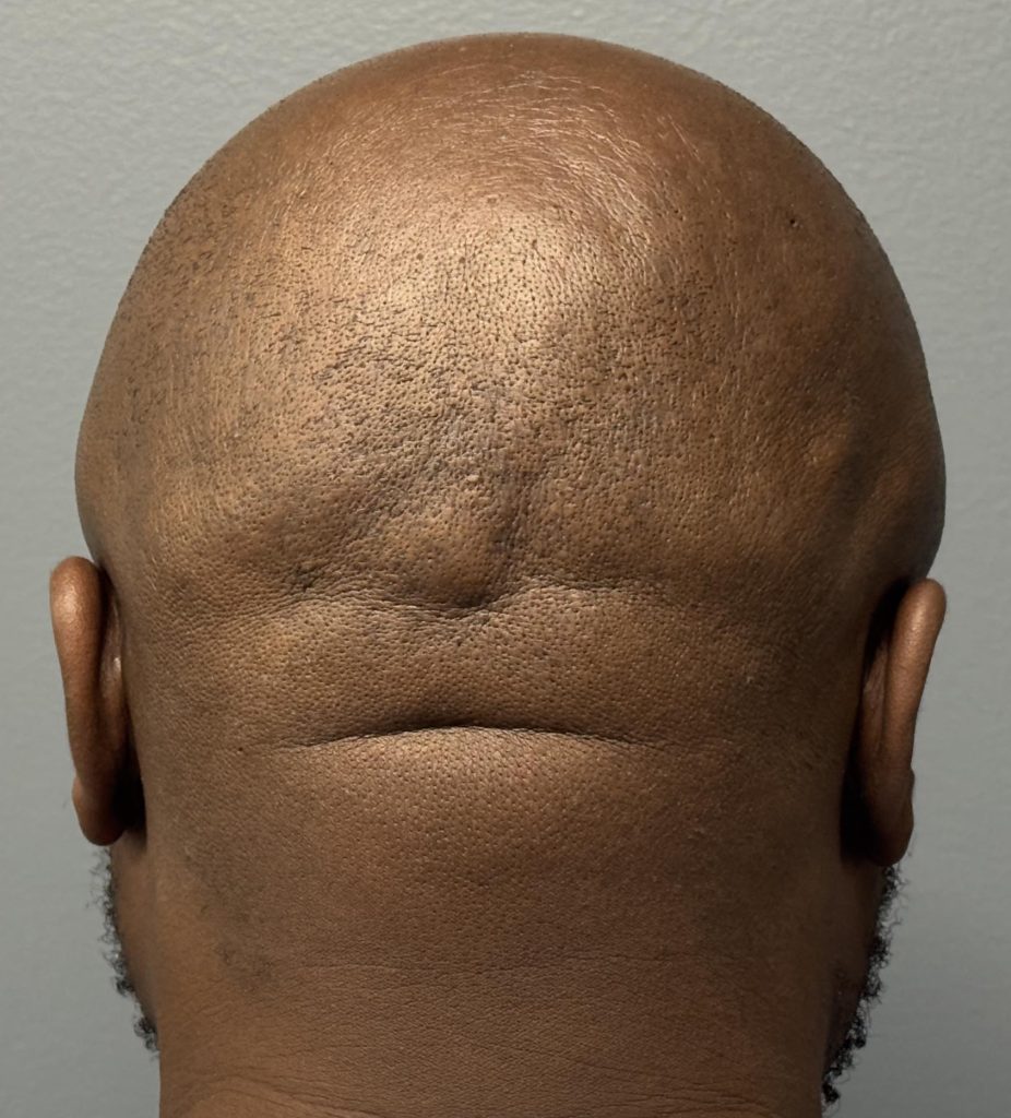 Total Temporal Muscle Reduction for Head Narrowing Case Example ...
