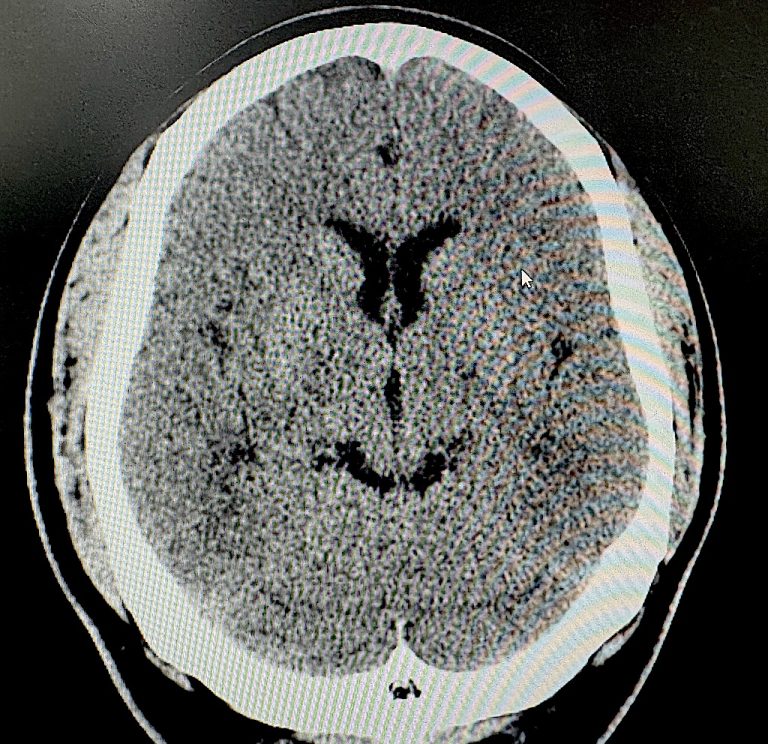 Total Temporal Muscle Reduction for Head Narrowing Case Example ...